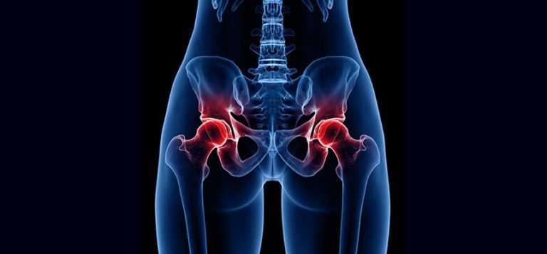 Artrosis de Cadera - Fisioterapia Talavera Martín Vasco