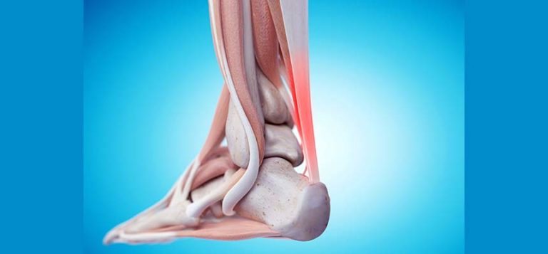 Tendinitis De Aquiles Fisioterapia Talavera Martín Vasco